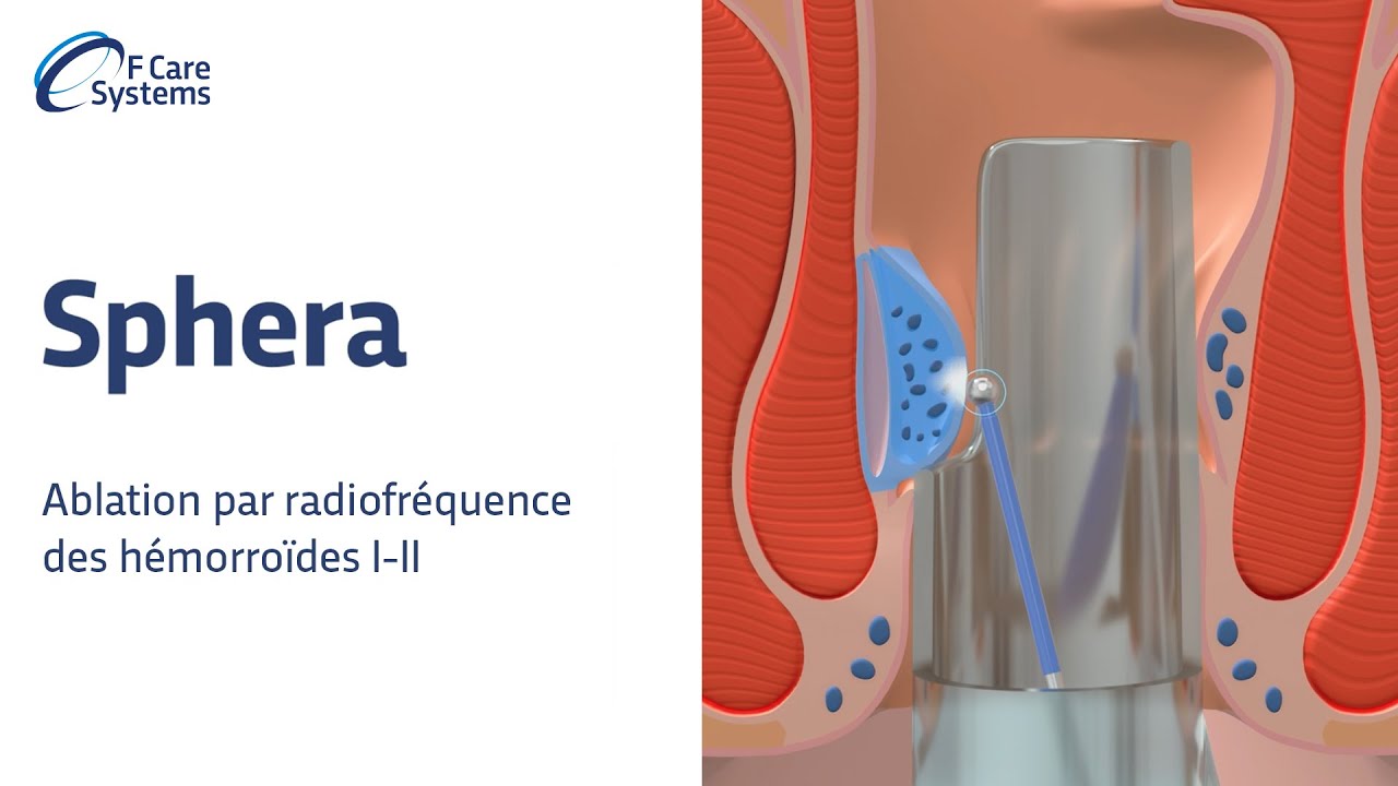 Ablation par radiofréquence des hémorroïdes grades I et II - Procédure Sphera (F Care Systems)
