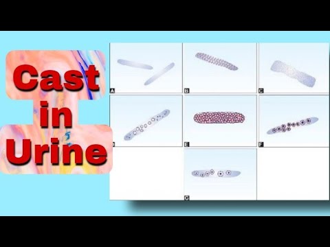 Cast in Urine|How to Identify Cast in Urine under Microscope |Urine Test|Stream Laboratory