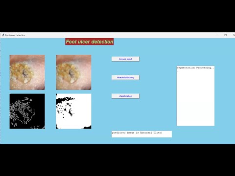 Foot Ulcer Detection System for Diabetic Patients | Aislyn