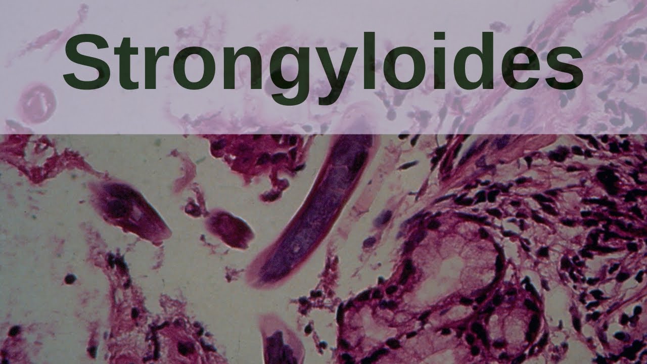 Strongyloides and Strongyloidiasis - Pathology mini tutorials