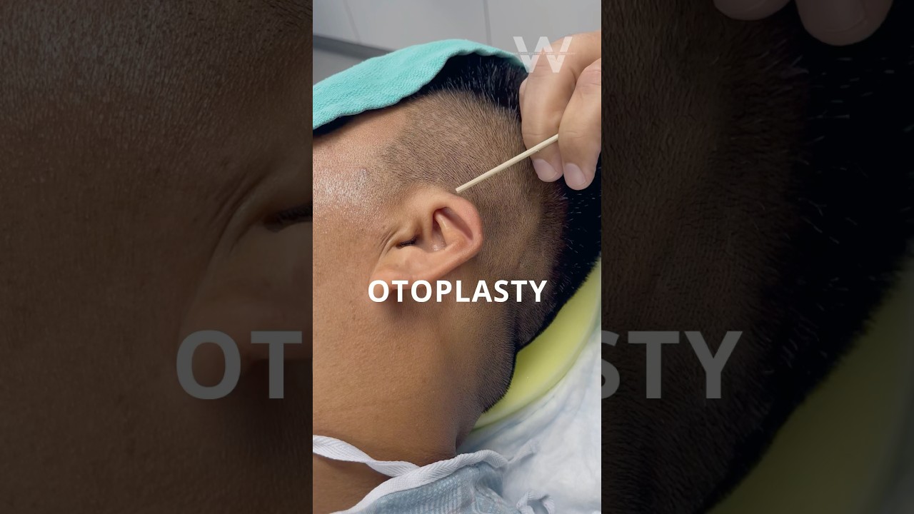 Otoplasty Ear Pinning Surgery explained by double board certified plastic surgeon Dr. Jeffrey Wise