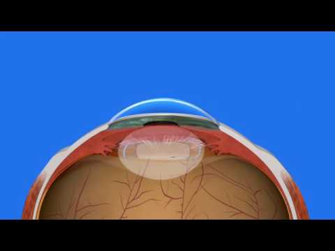 The Basics of Cataract Surgery
