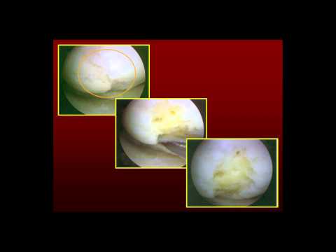 Dr. Lyndon Gross - Treatment of Articular Cartilage Injuries of the Knee