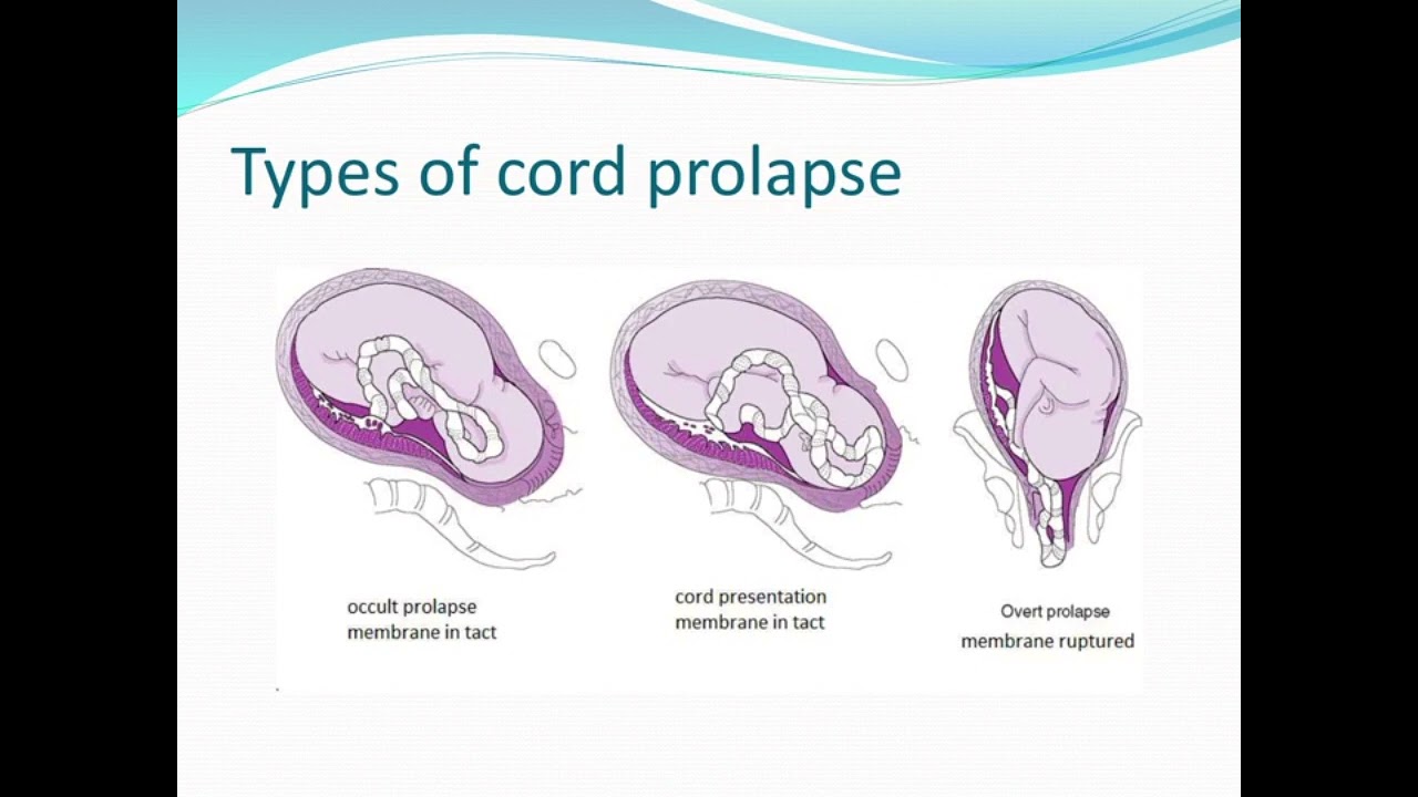 Cord Prolapse PPT Presentation Seminar Free Download