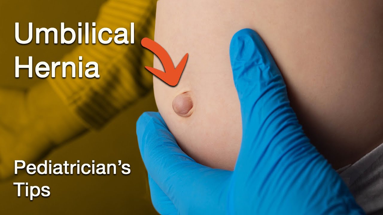 Should You Be Concerned About Your Child’s Umbilical Hernia? | AAP