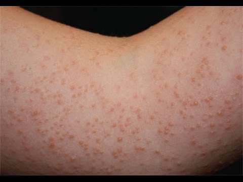 Comment guerir lucite estivale ? La réponse est sur Admicile.fr