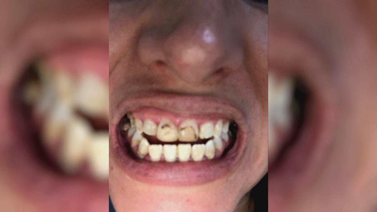 Smile Makeover for Nurse Struggling with her Teeth