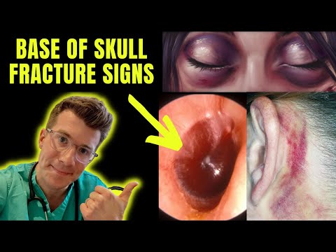 Clinical Signs of Base of Skull Fracture - including Racoon eyes, Battle's Sign & more!
