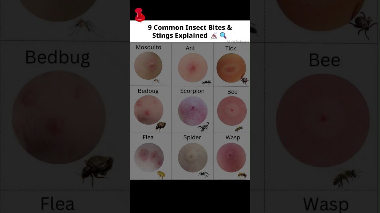 Insect Bites & Stings Explained 🐝