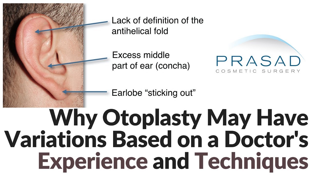 How Otoplasty (Ear Surgery) and its Aftercare can Vary Depending on a Doctor's Experience