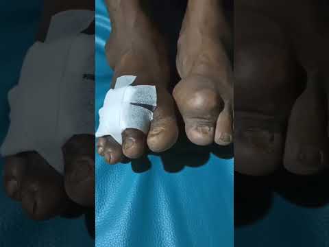 Tophus asam urat #shorts