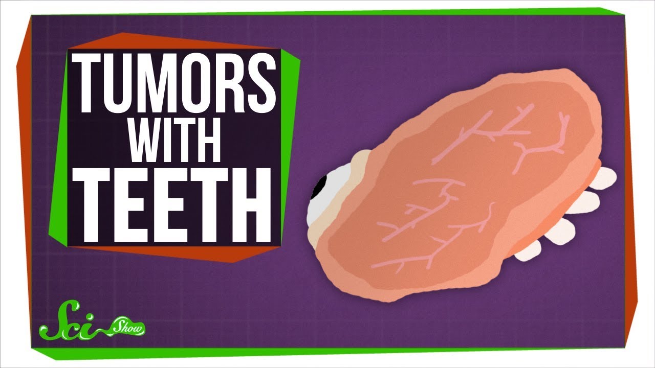 Teratomas: What Tumors with Teeth Can Teach Us About Stem Cells