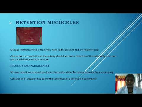 MUCOCELE