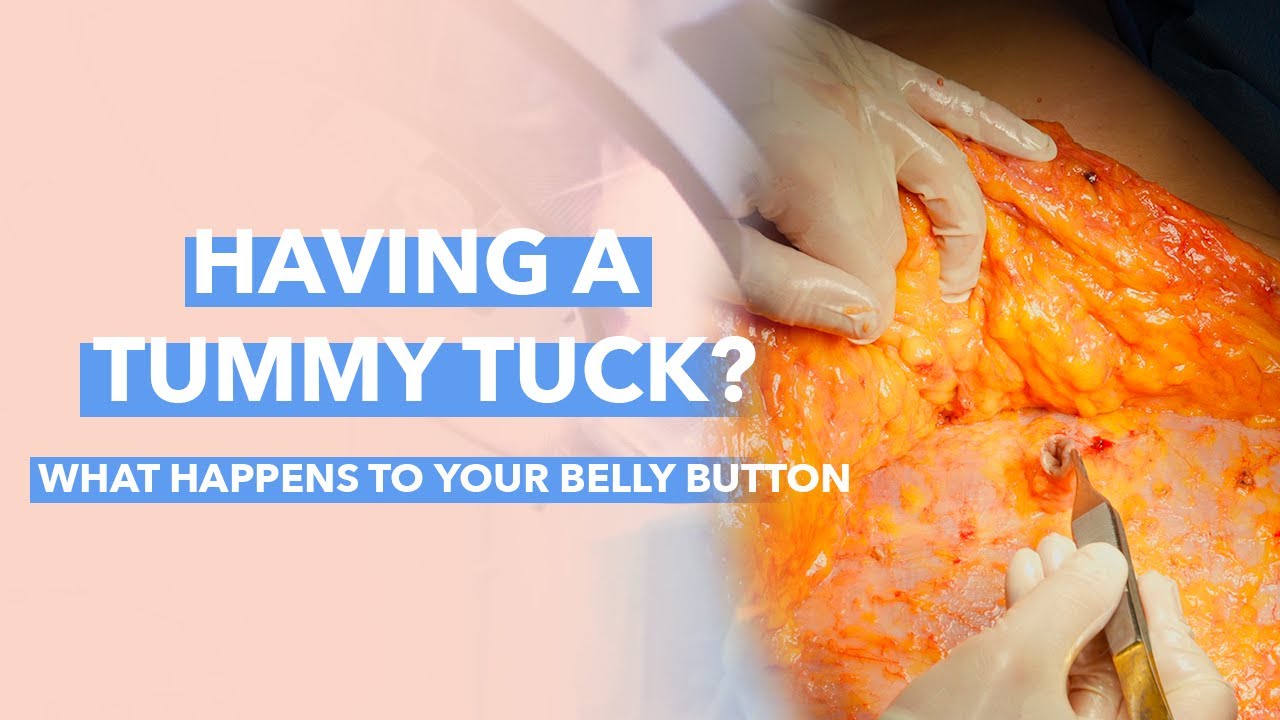 See What Happens To The Belly Button During A Tummy Tuck! Dr. Rahal Discusses Live Surgery!