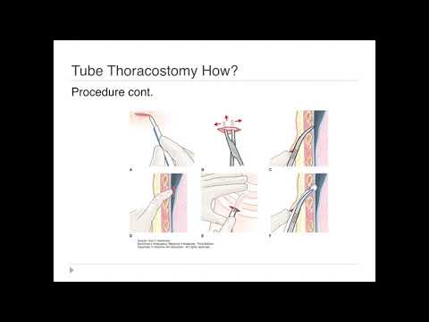 Dr Spencer Kim Tube Thoracostomy
