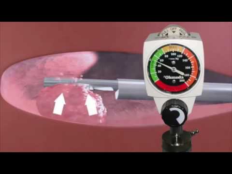 GYNE Education Video