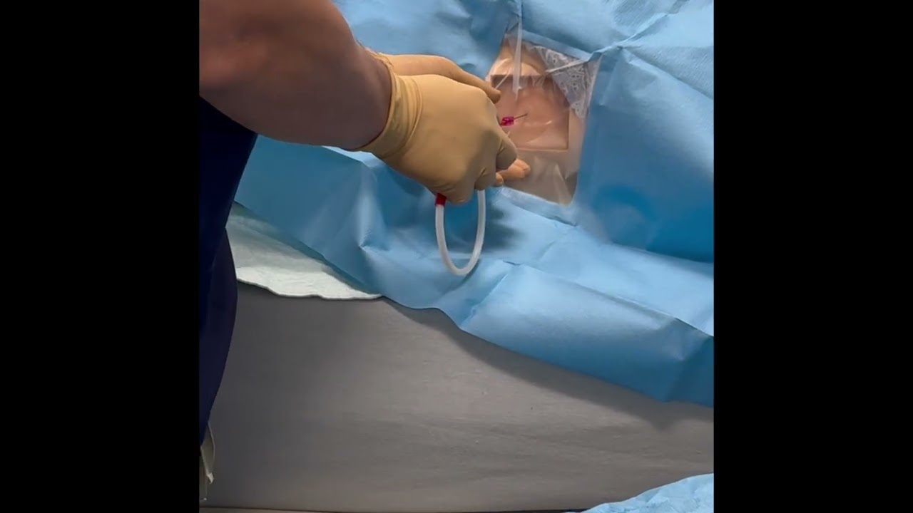 Wayne pneumothorax 14fr chest tube insertion