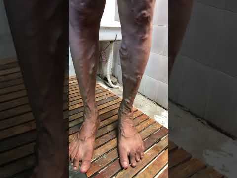 Varicose vein laser treatment is available at advance trauma & Multispeciality hospital Bhagalpur