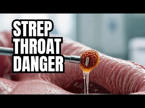 Strep Throat REVEALED: The Silent Throat Infection That Could Be Harming You!
