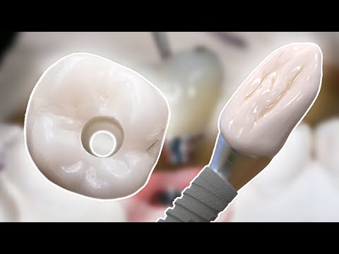 Two INCREDIBLE Options for Screw Retained Implant Crowns