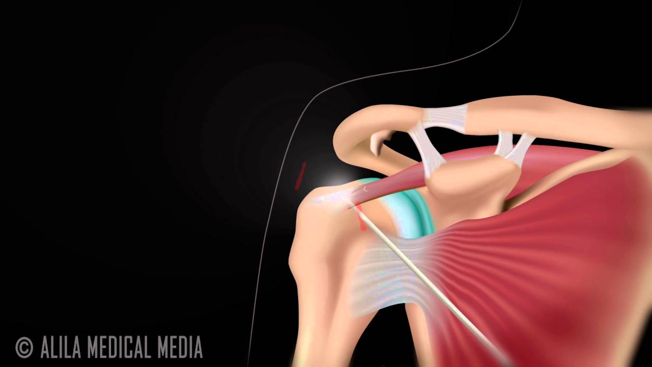 Arthroscopic Subacromial Decompression