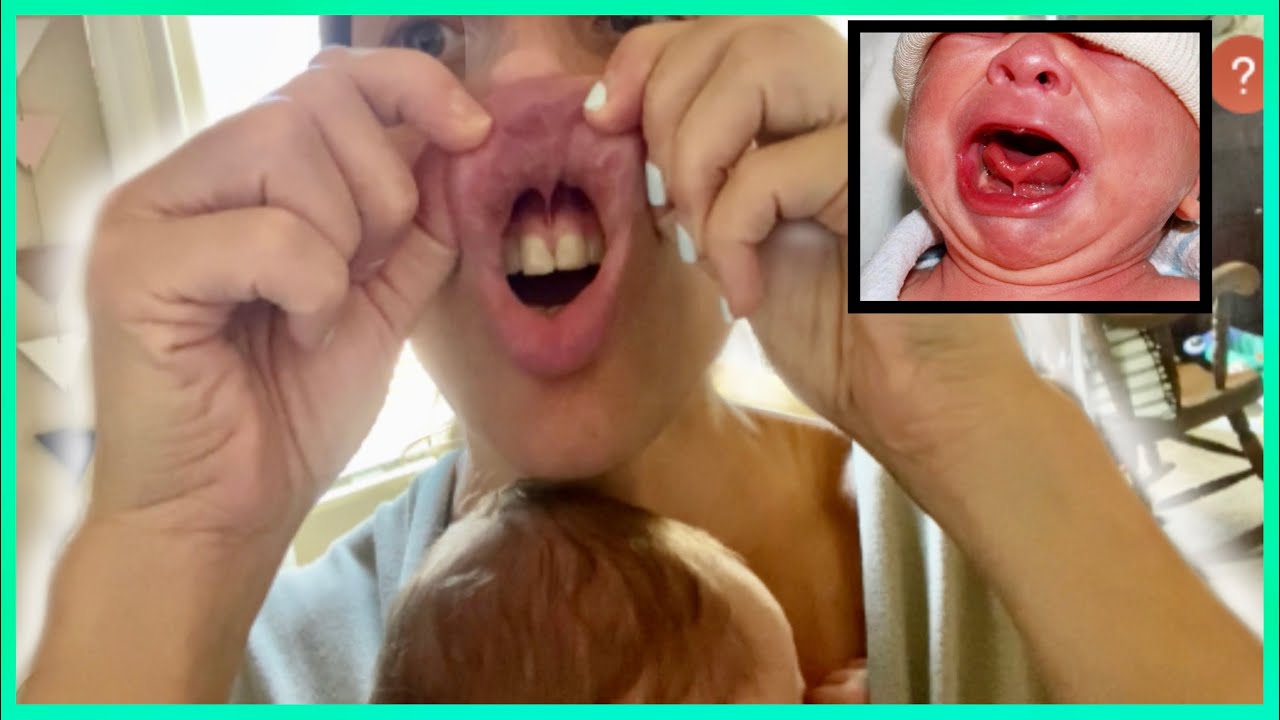 HIS FIRST SURGERY || LIP TIE/ TONGUE TIE (Frenectomy)