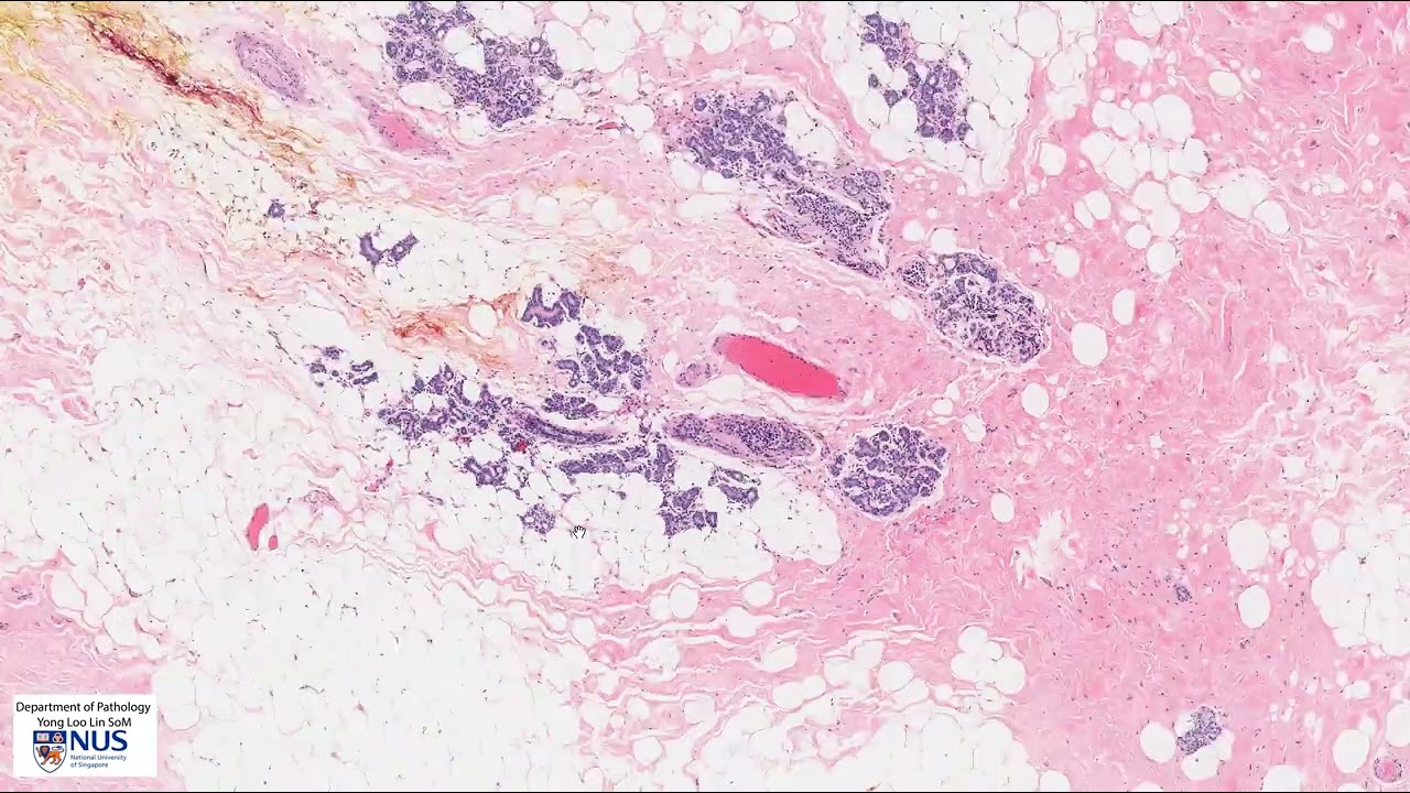 Breast: Fibrocystic change microscopy - Talking slide