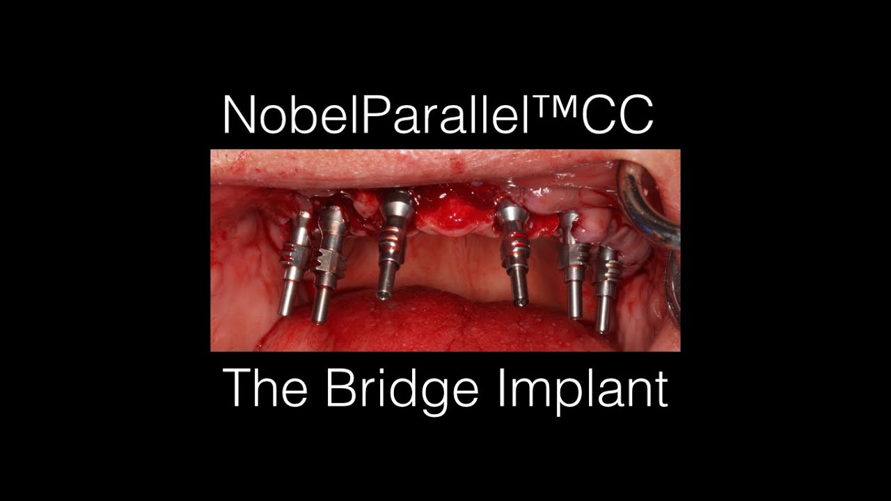 The Dental Implant for Bridges