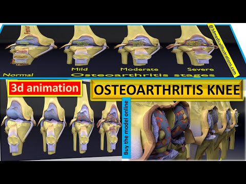 ⚕️ knee osteoarthritis stages 3d blend・ 3D File for 3D printing・Cults