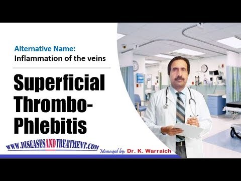 Superficial Thrombophlebitis : Causes, Diagnosis, Symptoms, Treatment, Prognosis