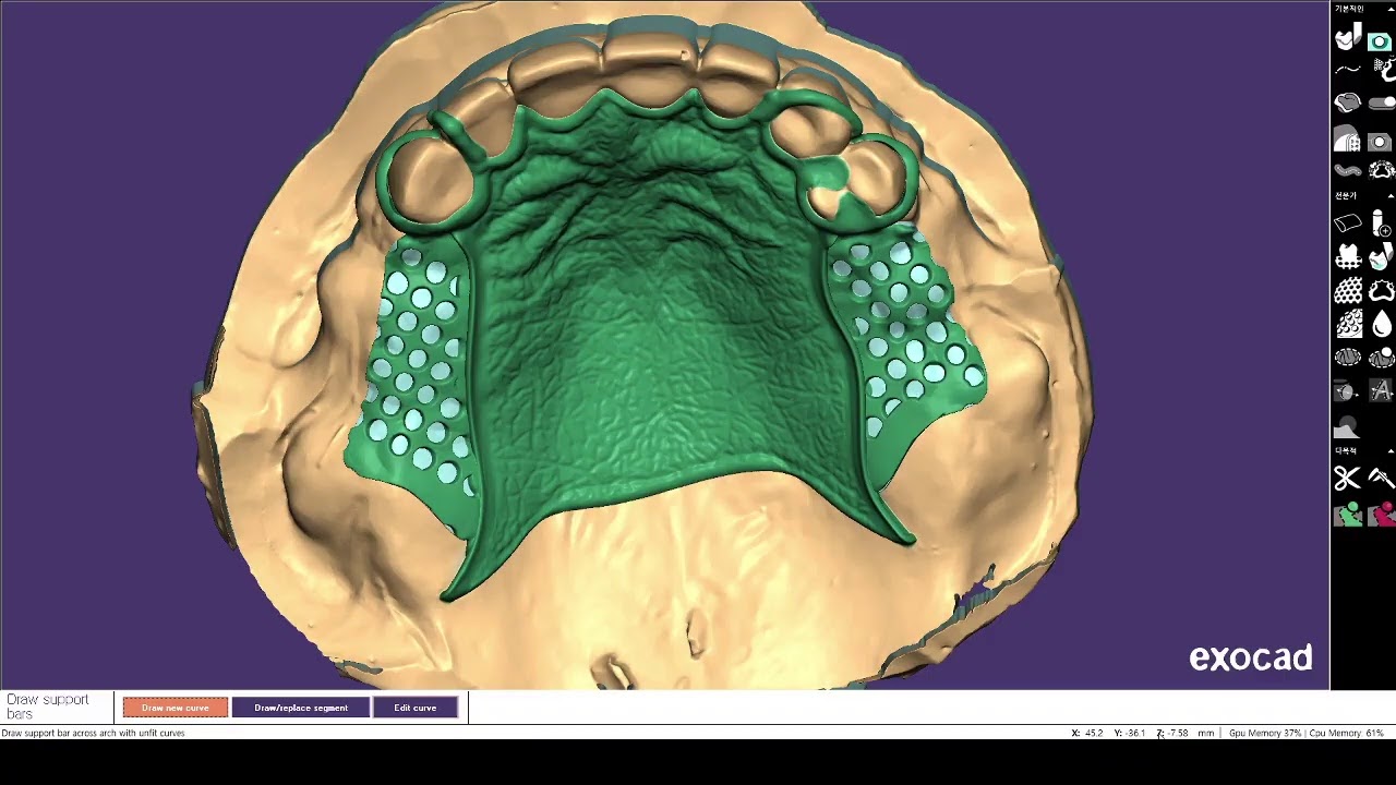 Exocad partial denture framework design -Style GONJO