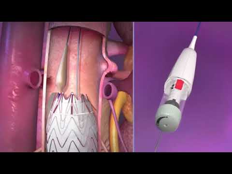 Gore C3 Excluder AAA Endoprosthesis Deployment
