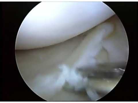 MoraMD: What is a Arthroscopic Clean Up Surgery of the Knee by Dr Steve Mora