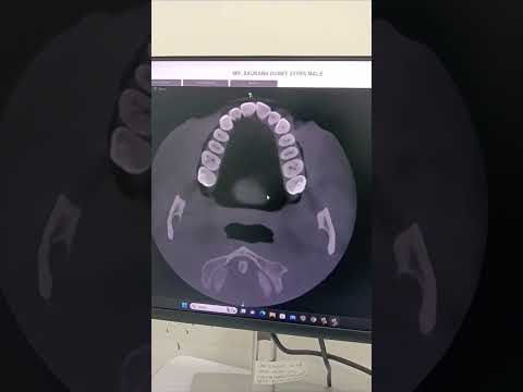 CBCT full mouth pre Implant | Dental CT Scan #3d #anatomy #cbct #video #trending #viral #2d