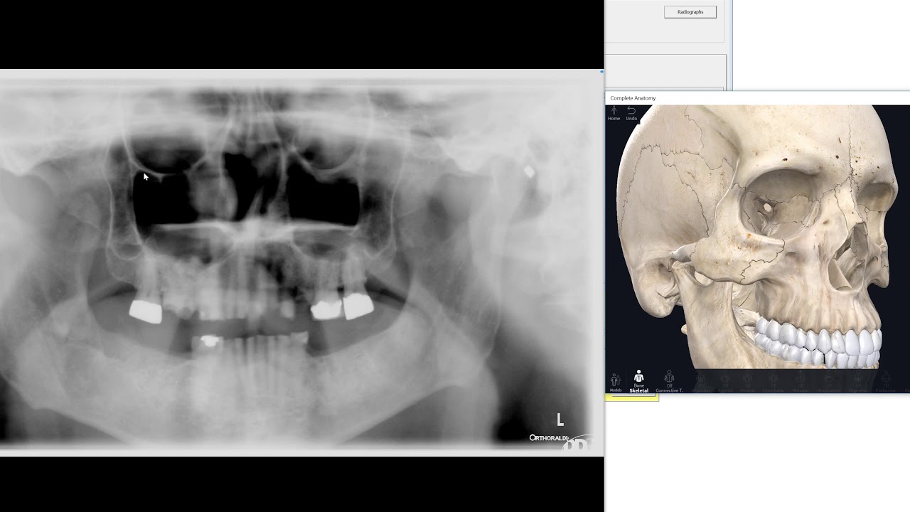 zygoma zygomatic arch pterygoid plate on pano