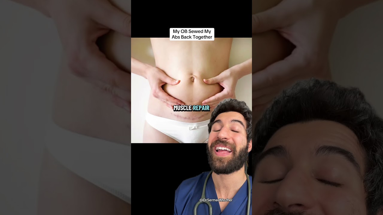 “My OB Sewed My Abs Back Together” #csection