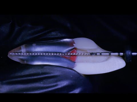 Cleaning and Shaping of root canal - Step Back technique