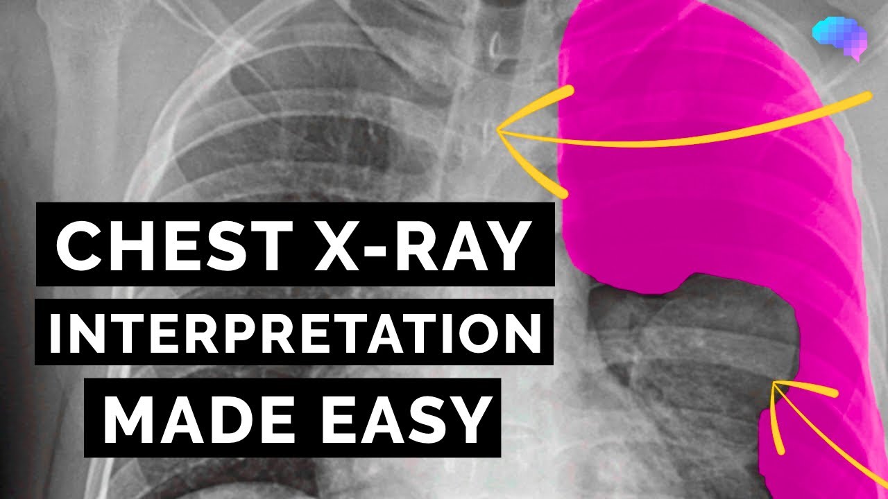Mastering Chest X-ray Interpretation: A Comprehensive Guide | Galaxy.ai