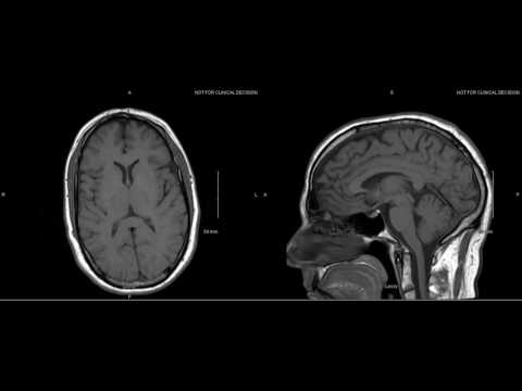 Unremarkable Non-Contrast Brain MRI: Sagittal T1-Example 1