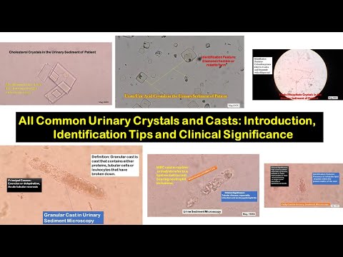 All common Crystals and Casts of Urine:Introduction, Identification and clinical significance