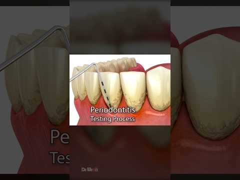 Periodontitis and Laser Hardening Surgery: 3D Animation