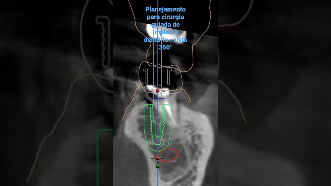 -Planejamento Cirúrgico de Implante Dentário vista 360°: Tudo o que Você Precisa Saber ​
