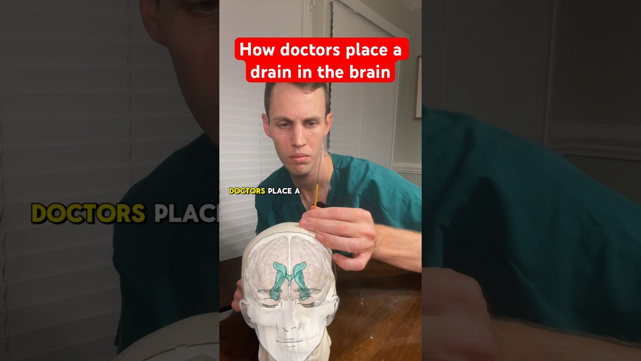 Placing a ventricular drain into the brain #brain #neurosurgery