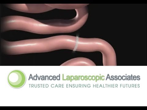 The Roux-en-Y Gastric Bypass Procedure