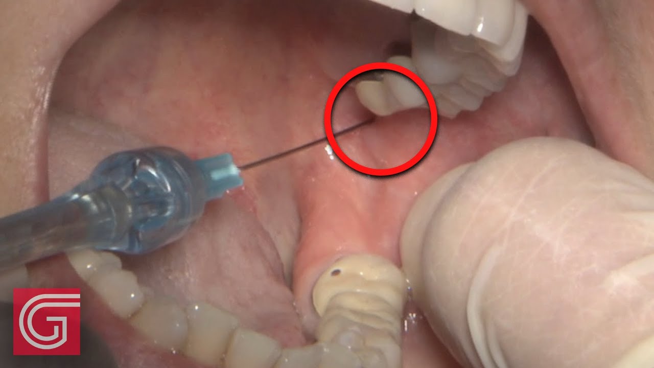 Mastering the Gow Gates Dental Injection: A Beginner's Guide | Galaxy.ai