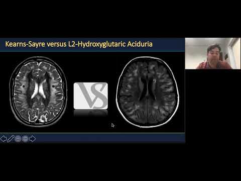 Imaging in Mitochondrial diseases by Dr Cesar Alves