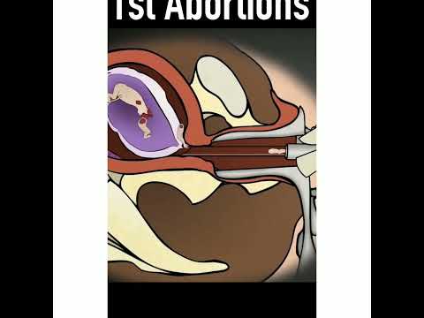 3D animation of abortion|| abortion kaise hota hai🤰