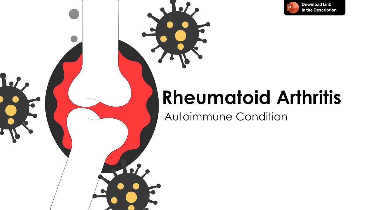 Rheumatoid Arthritis PowerPoint Presentation - Definition, Pathophysiology, Diagnosis and Management