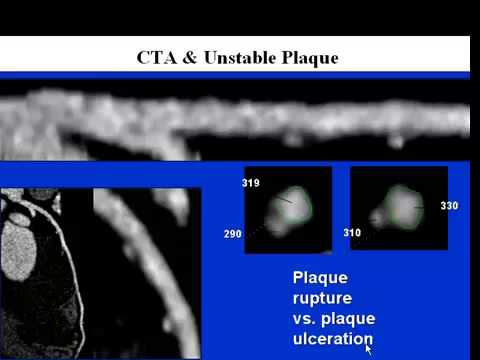 CCTA Training Lecture 7C Contrast CT Coronary Angiography