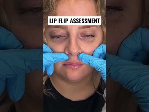 How a Botox lip flip works 💉 #reels #lipflip #botox #botoxinjections
